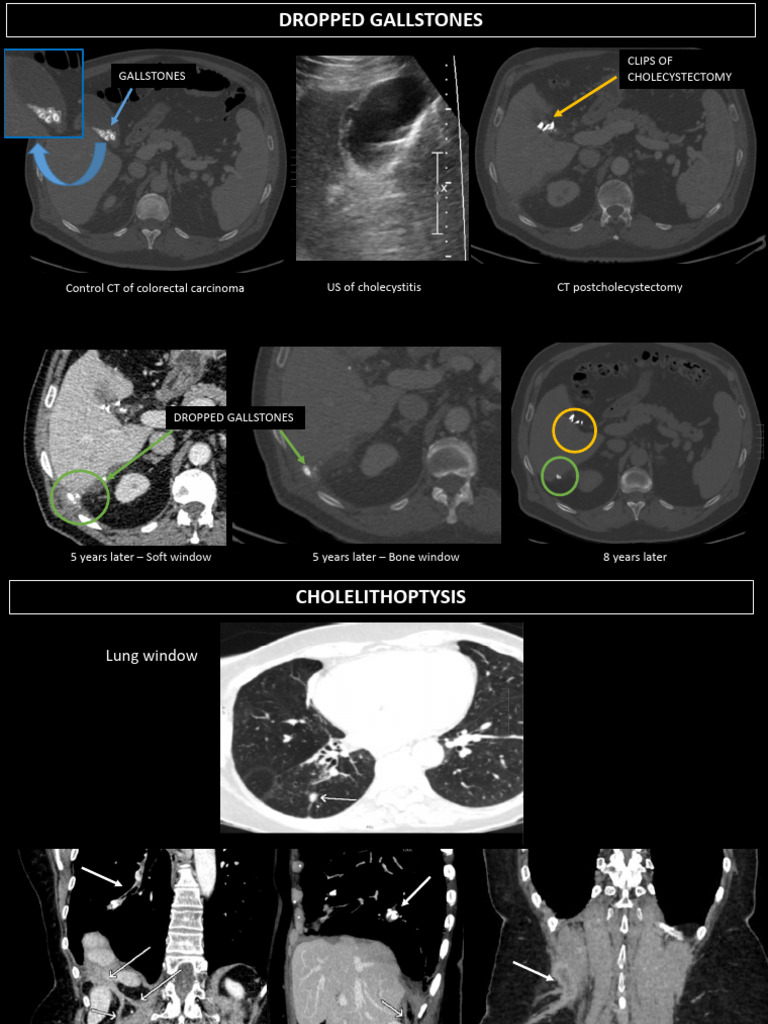Dropped Lithiasis Complications and Pitfalls. What To Look For! | PDF
