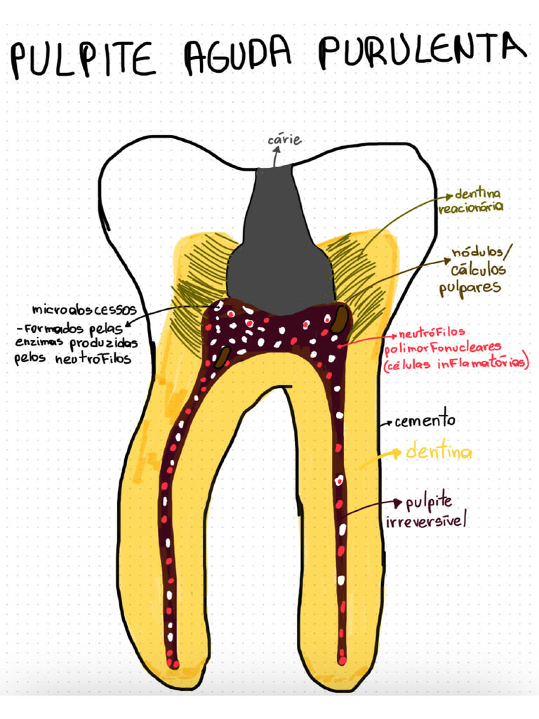 Pulpite Aguda Purulenta | PDF