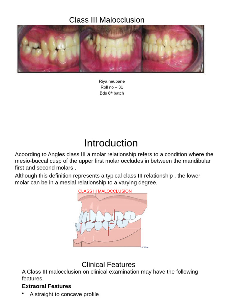 Class III Malocclusion | PDF