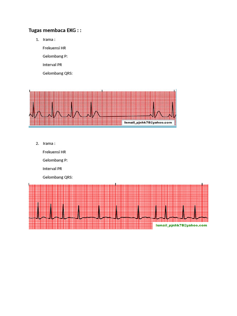 Tugas Membaca EKG 24-25 | PDF