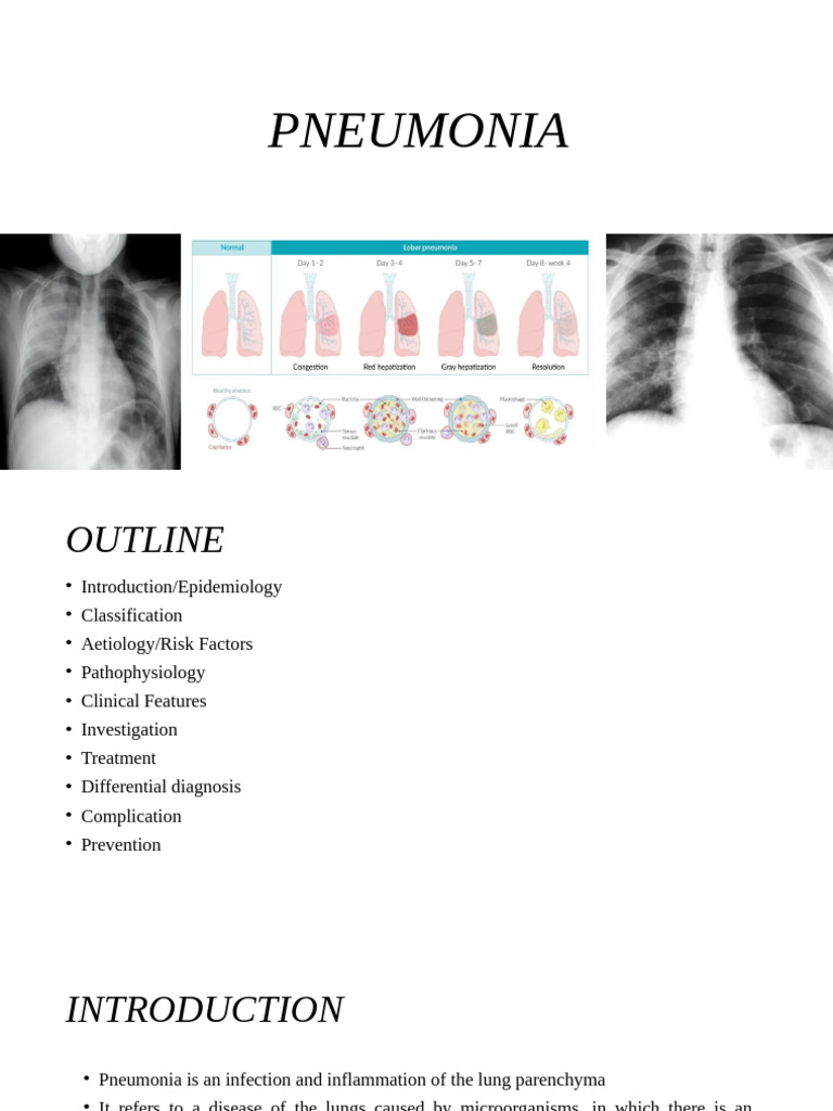 Pneumonia | PDF