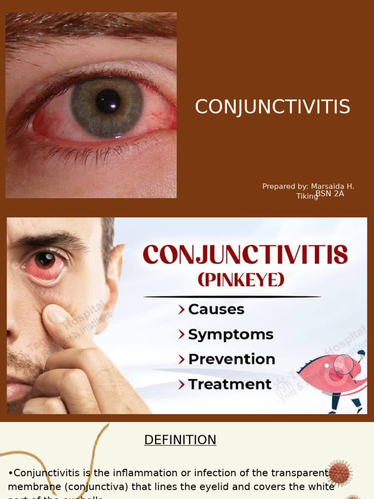 CONJUNCTIVITIS WPS ,PPT | PDF