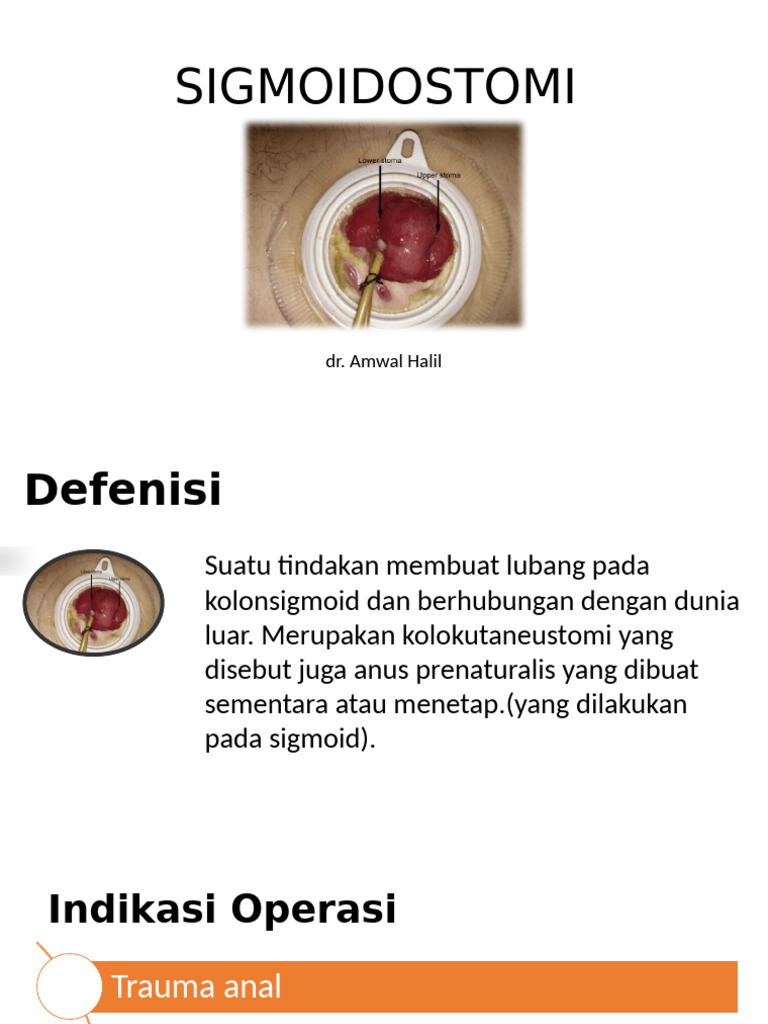 TO SIGMOIDOSTOMI Dr. AW | PDF