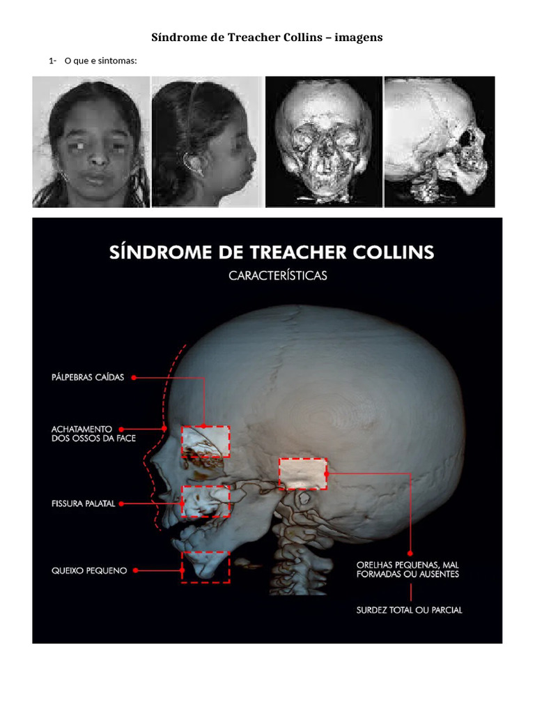 Síndrome de Treacher Collins - Imagens - Samanta | PDF