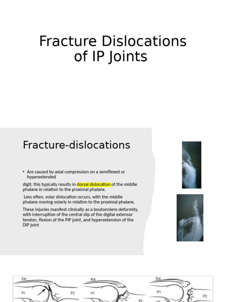 Fracture Dislocation IP | PDF