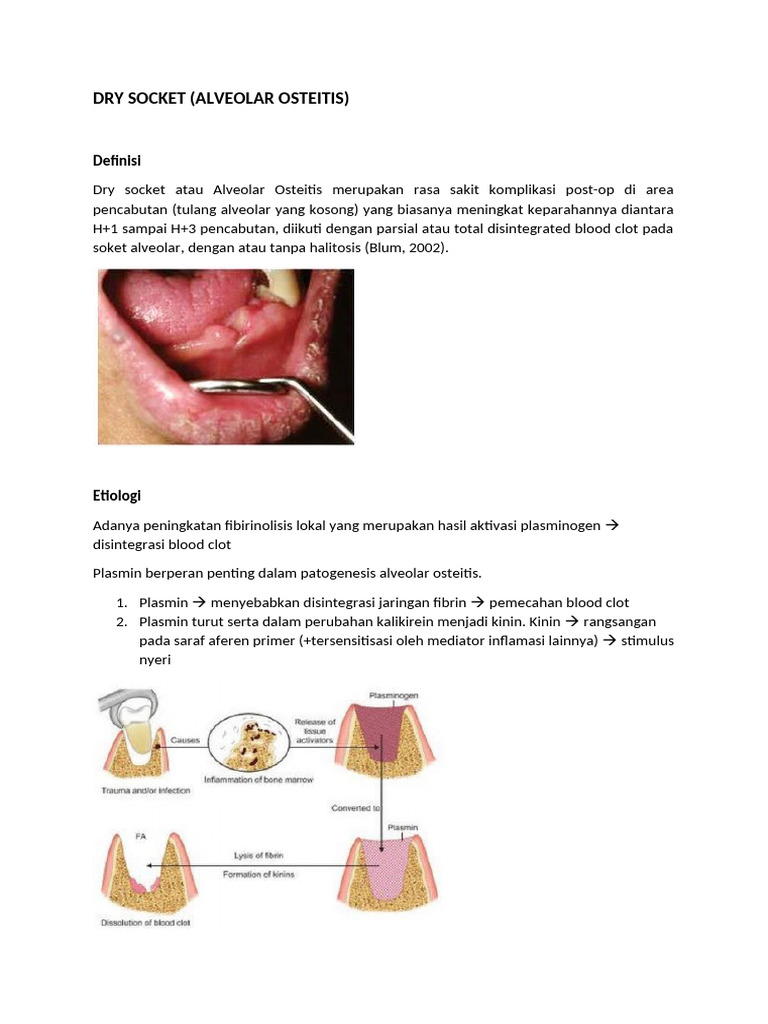 Dry Socket | PDF | Medical Specialties | Wellness
