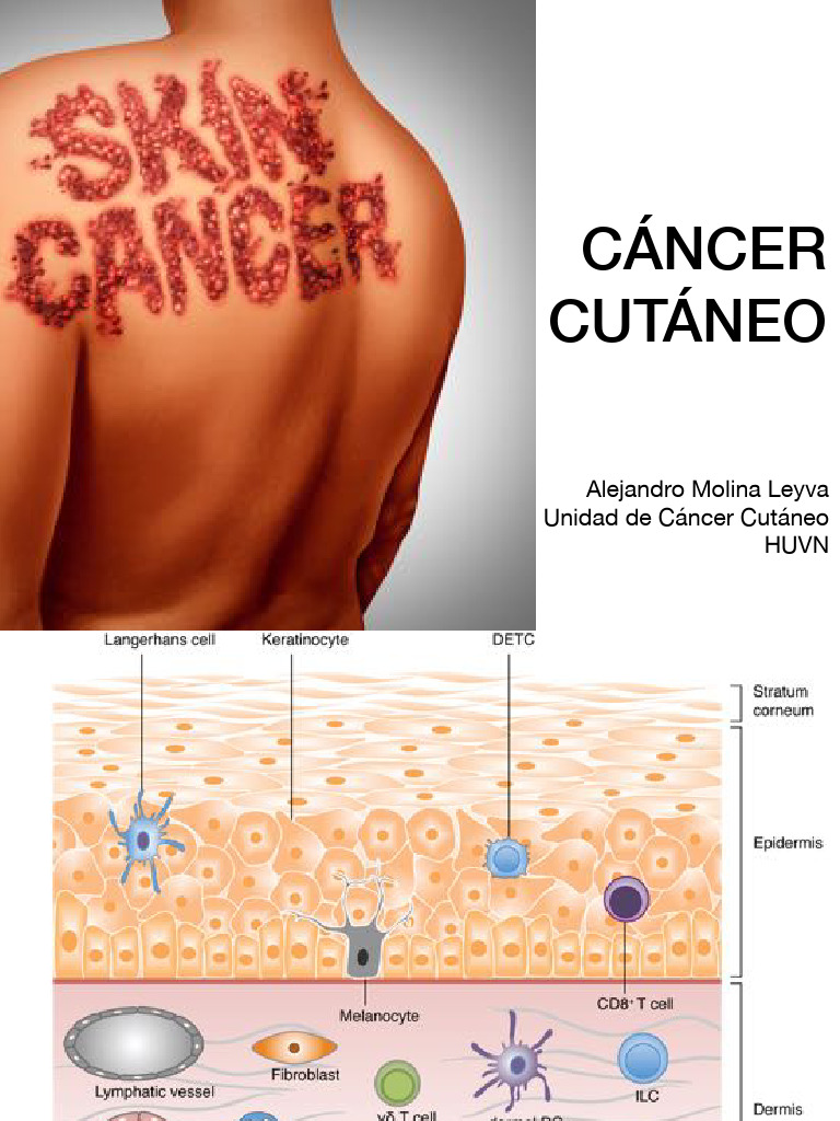 Sesion Cancer Cutaneo | PDF