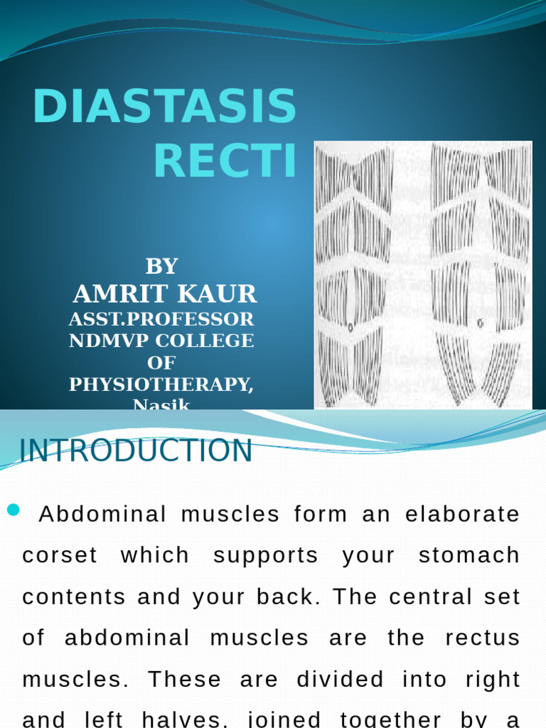 DIASTASIS RECTI (2) | PDF