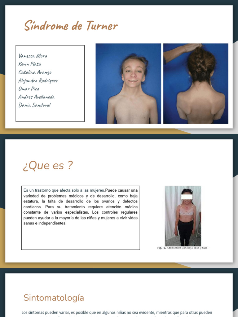 Síndrome de Turner | PDF