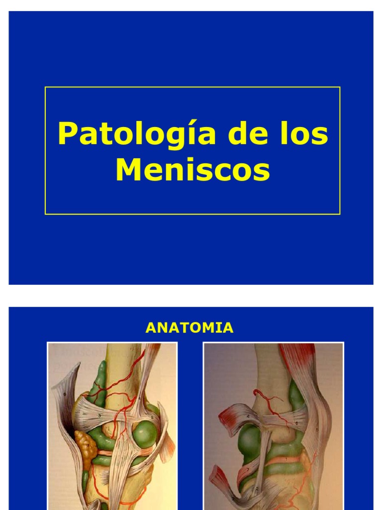Causas y diagnóstico del desgarro meniscal | PDF | Rodilla | Articulaciones
