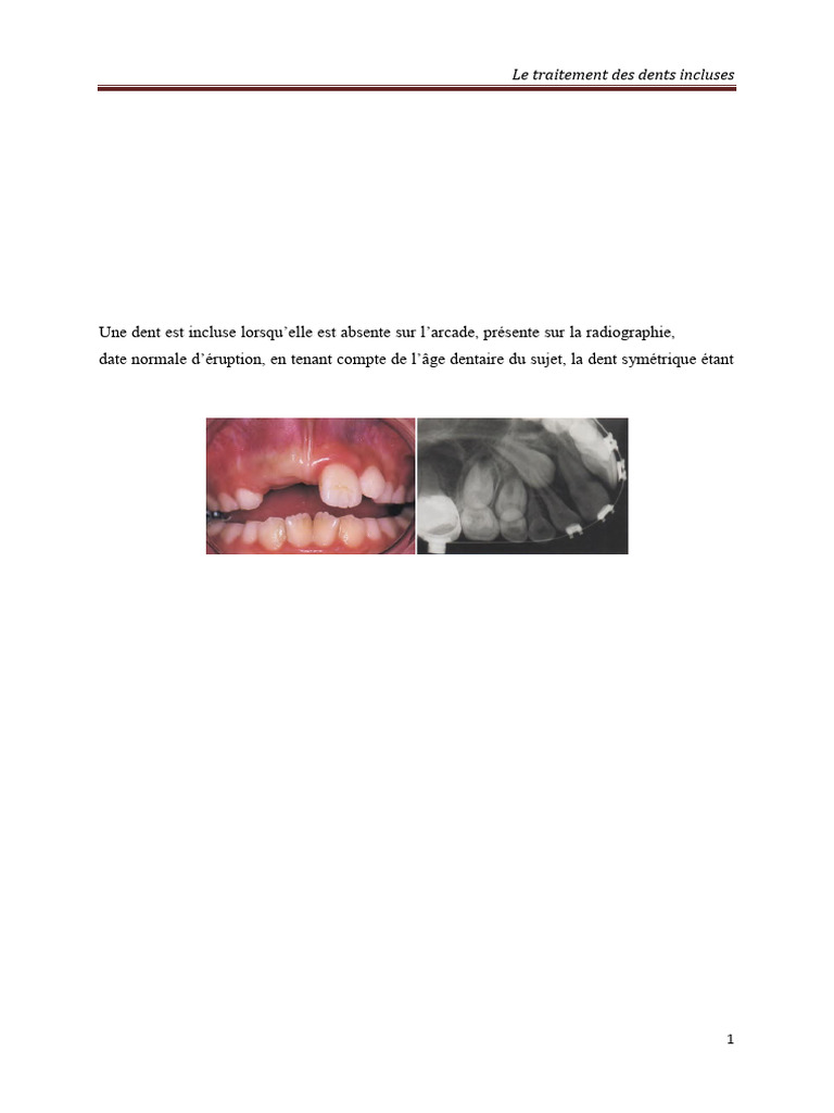 7 ODF Le Traitement Des Dents Incluses | PDF