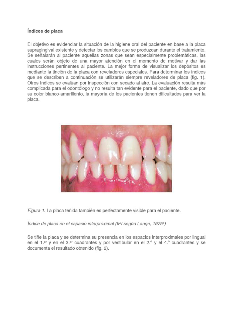 Índices de Placa e Higiene Oral | PDF | Especialidades médicas ...