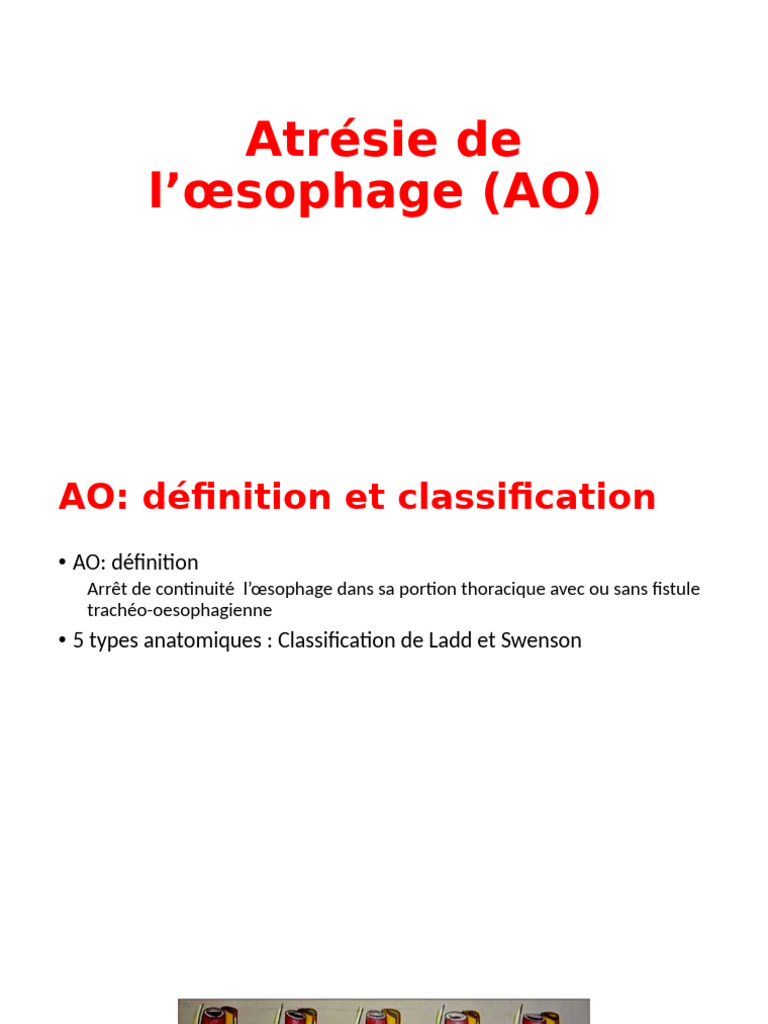 Atresie de L Oesophage | PDF