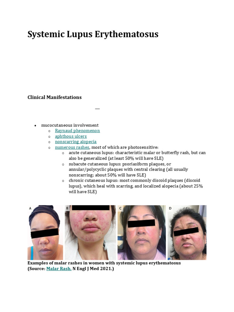 Systemic-Lupus-Erythematosus | PDF