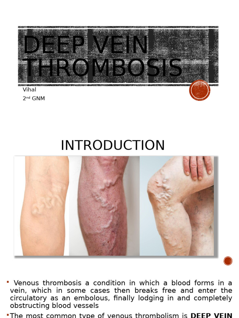 Deep Vein Thrombosis | PDF