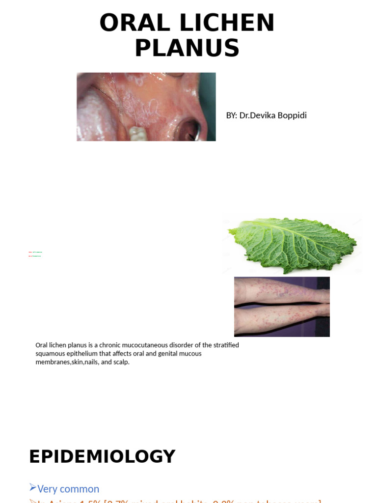 Oral Lichen Planus | PDF
