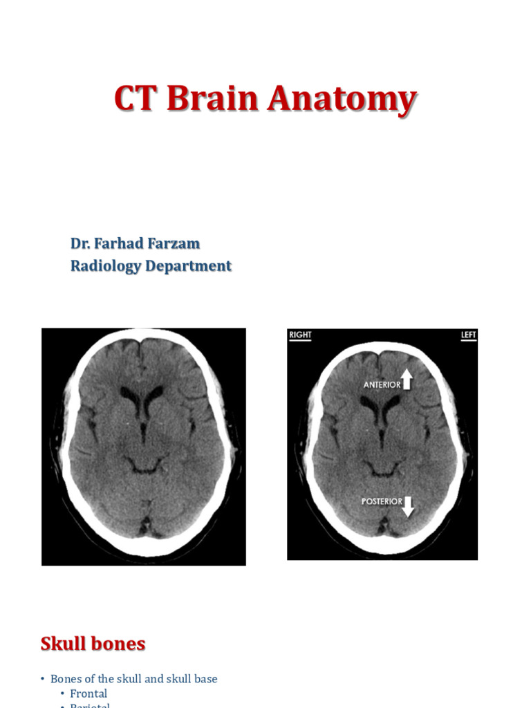 Brain CT Anatomy-1 - 221008 - 173953 | PDF