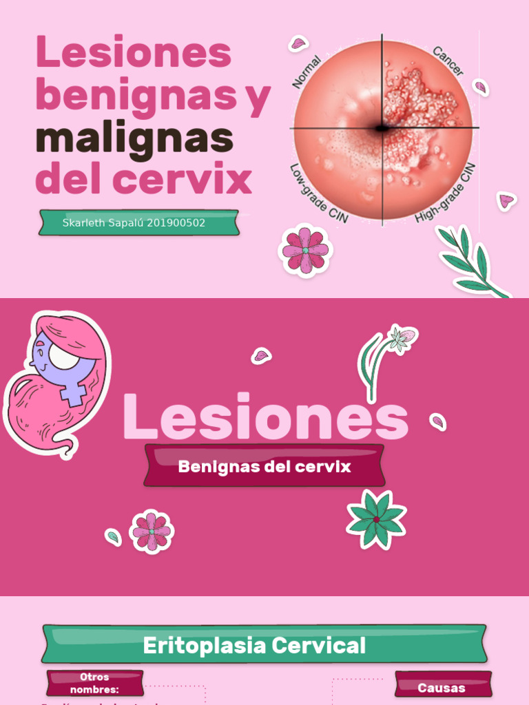 Lesiones Benignas y Malignas Del Cervix | PDF