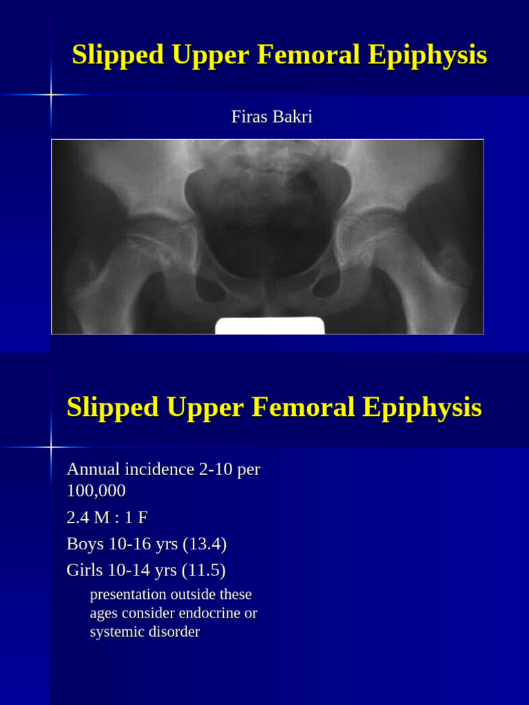 SCFE | PDF
