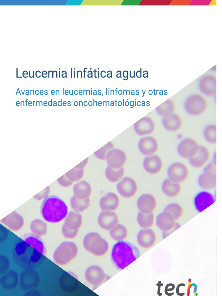Leucemia Linfática Aguda | PDF