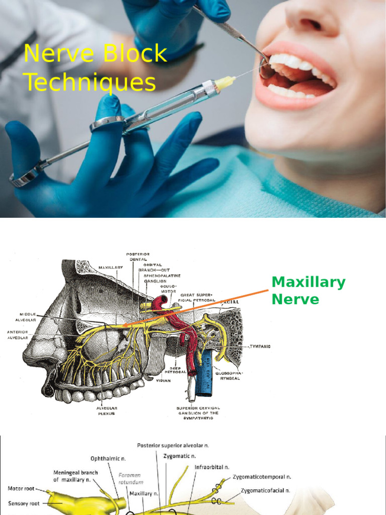 Nerve Block Techniques | PDF