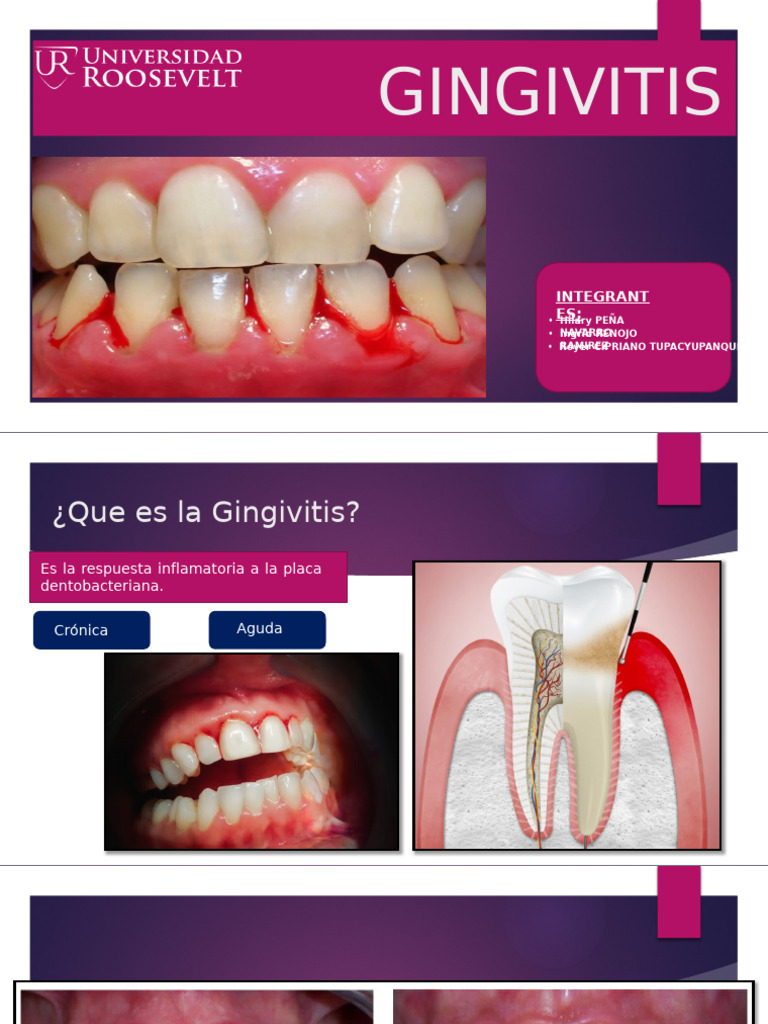 Gingivitis | PDF