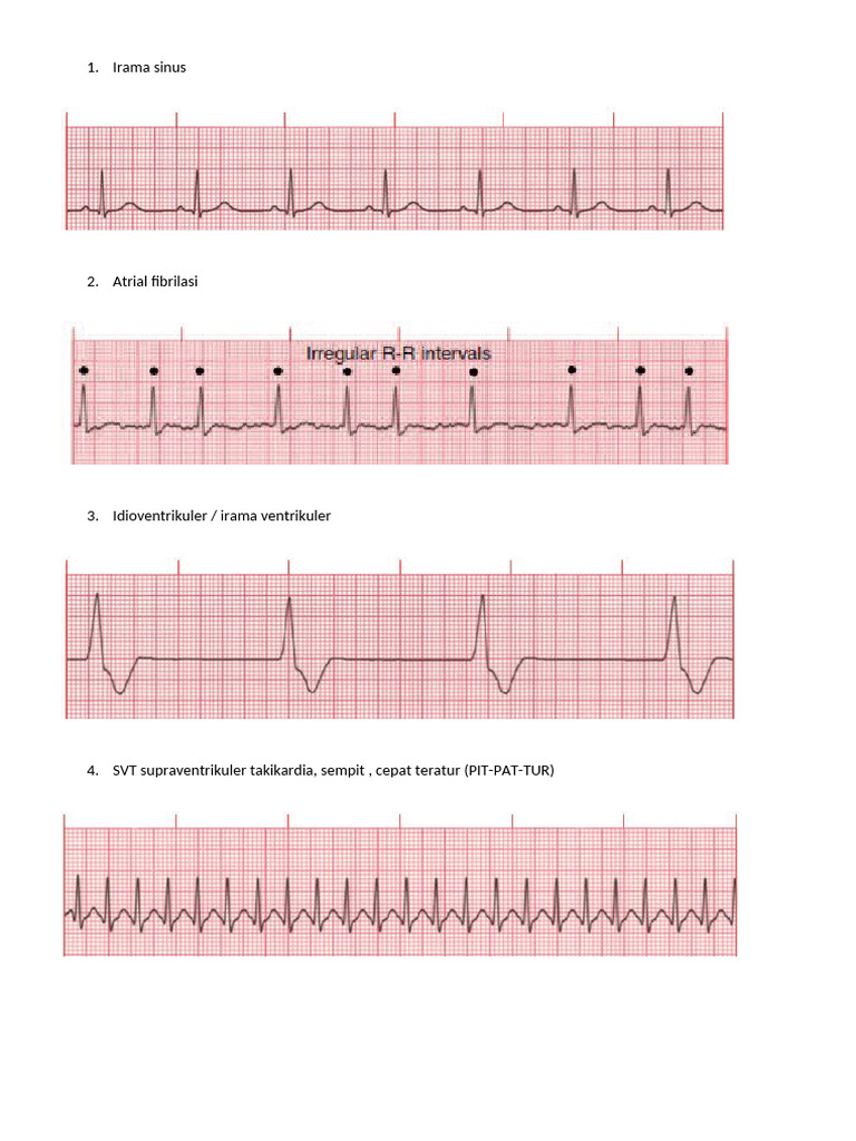 Gambar EKG | PDF