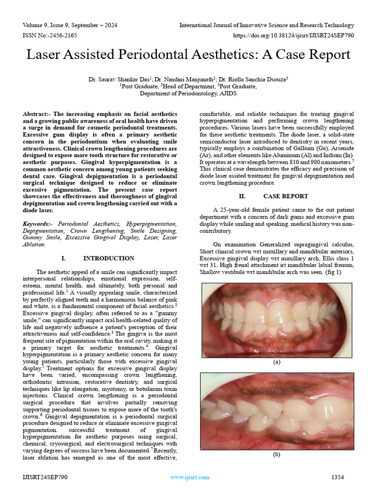 Laser Assisted Periodontal Aesthetics: A Case Report | PDF