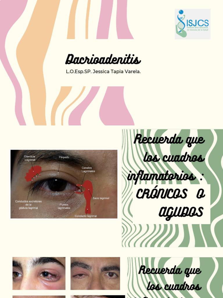 Dacrioadenitis y Dacriocistitis | PDF