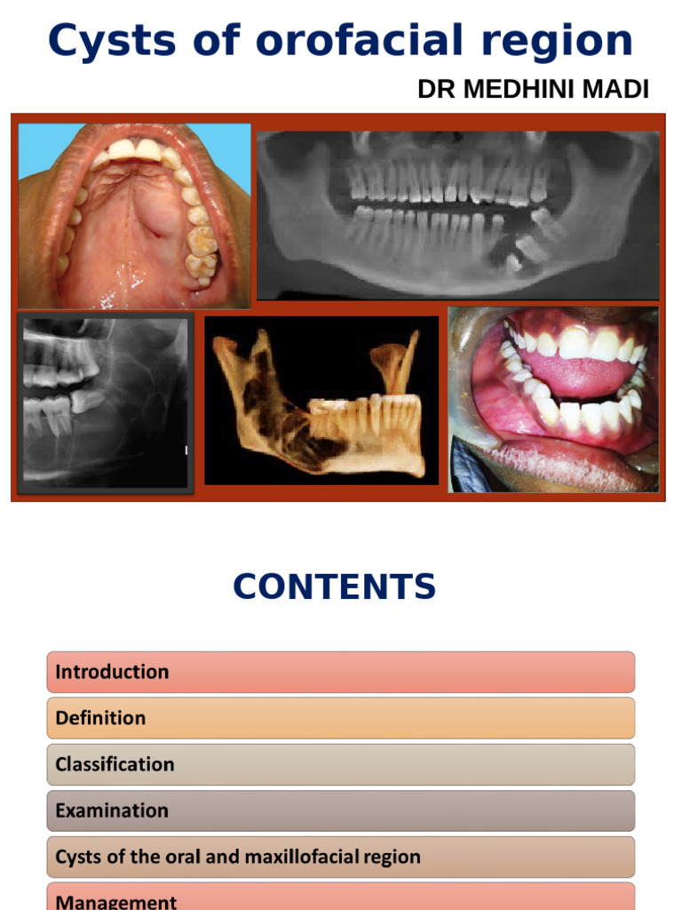 Cysts of The Orofacial Region | PDF