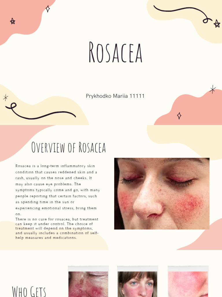 Rosacea | PDF