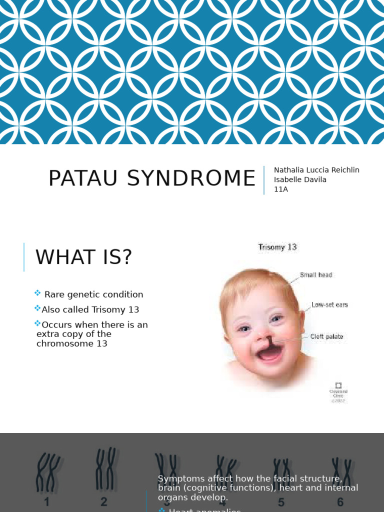 Patau Syndrome | PDF