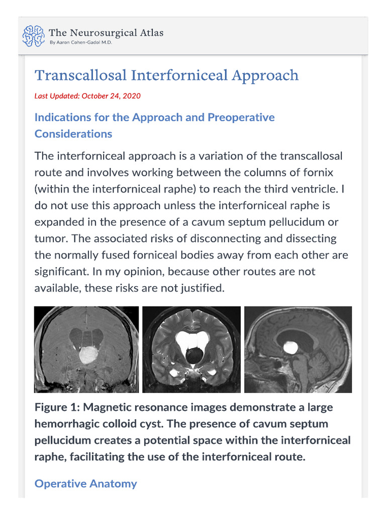 Transcallosal Interhmemishperic Approach | PDF