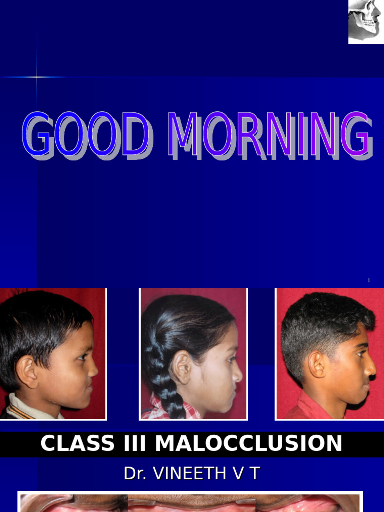 Class III Malocclusion | PDF