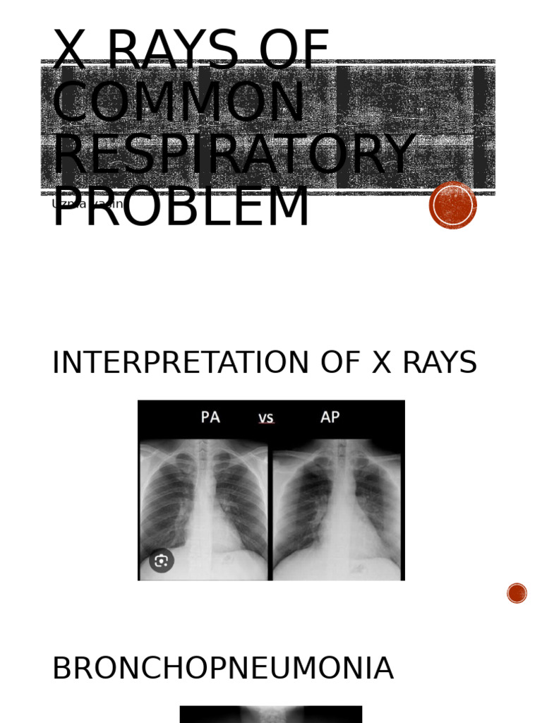 X Rays of Common Respiratory Problem: Uzma Yasin | PDF