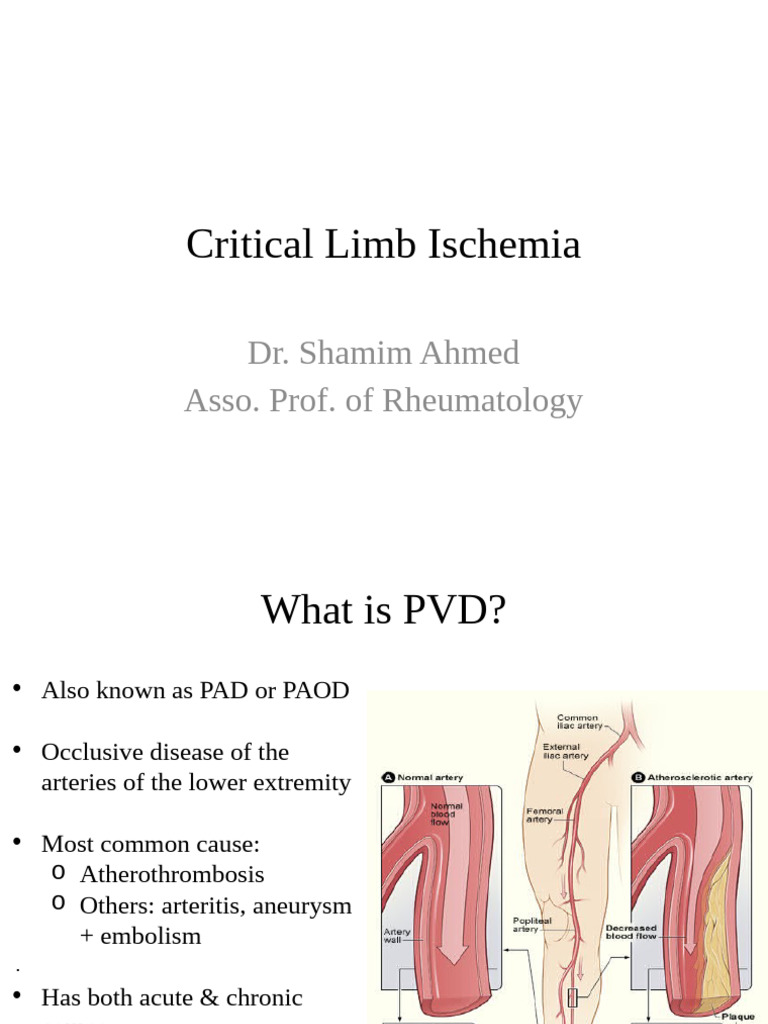 Critical Limb Ischemia | PDF