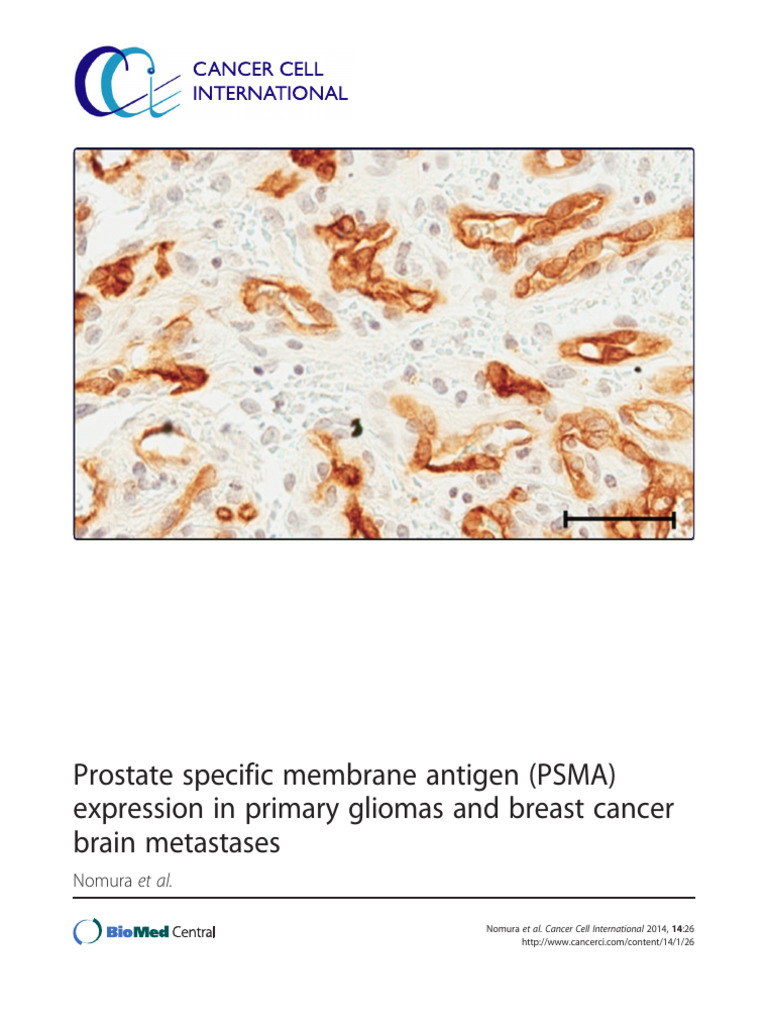 Prostate Specific Membrane Antigen (PSMA) Expression in Primary Gliomas ...