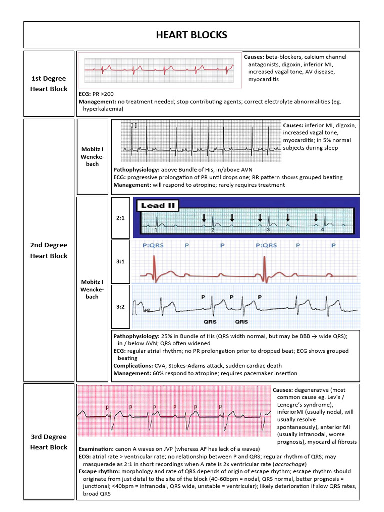 Heart Blocks | PDF