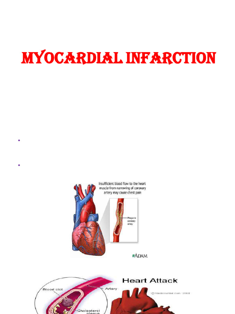 Myocardial Infarction | PDF