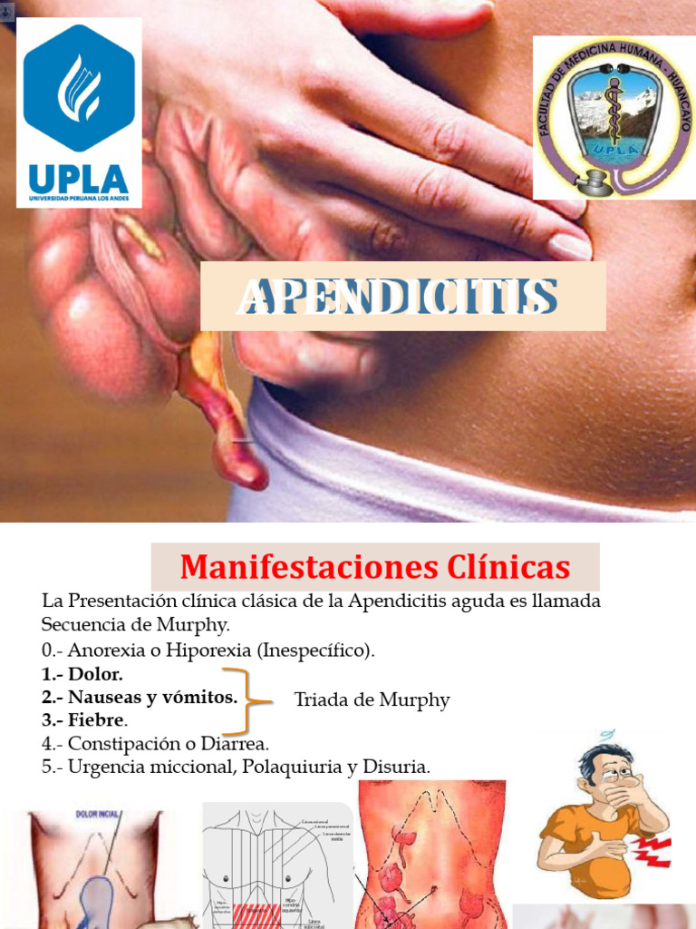 Apendicitis | PDF
