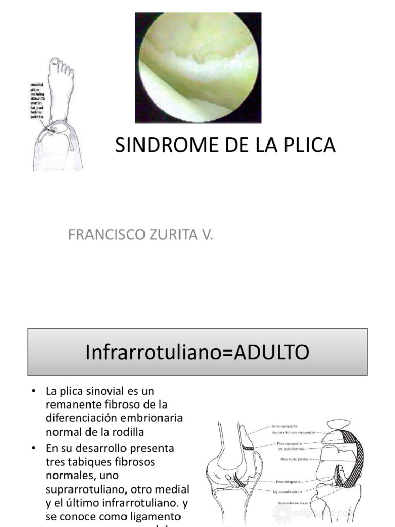 Sindrome de La Plica | PDF