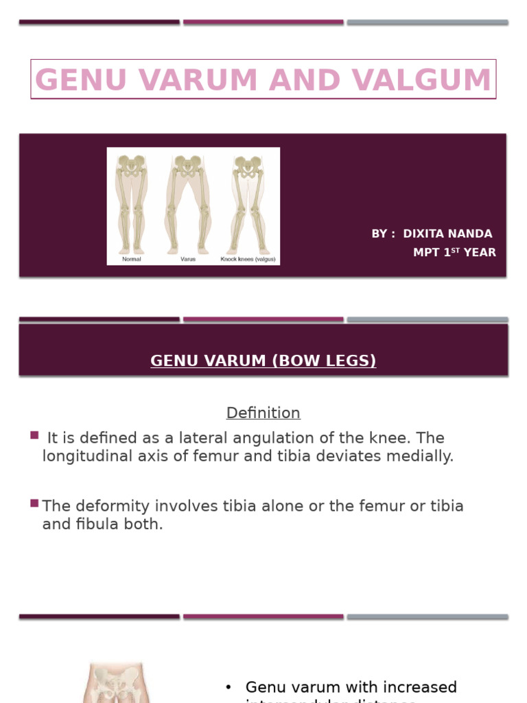 3rd Year Genu Varum and Valgum | PDF