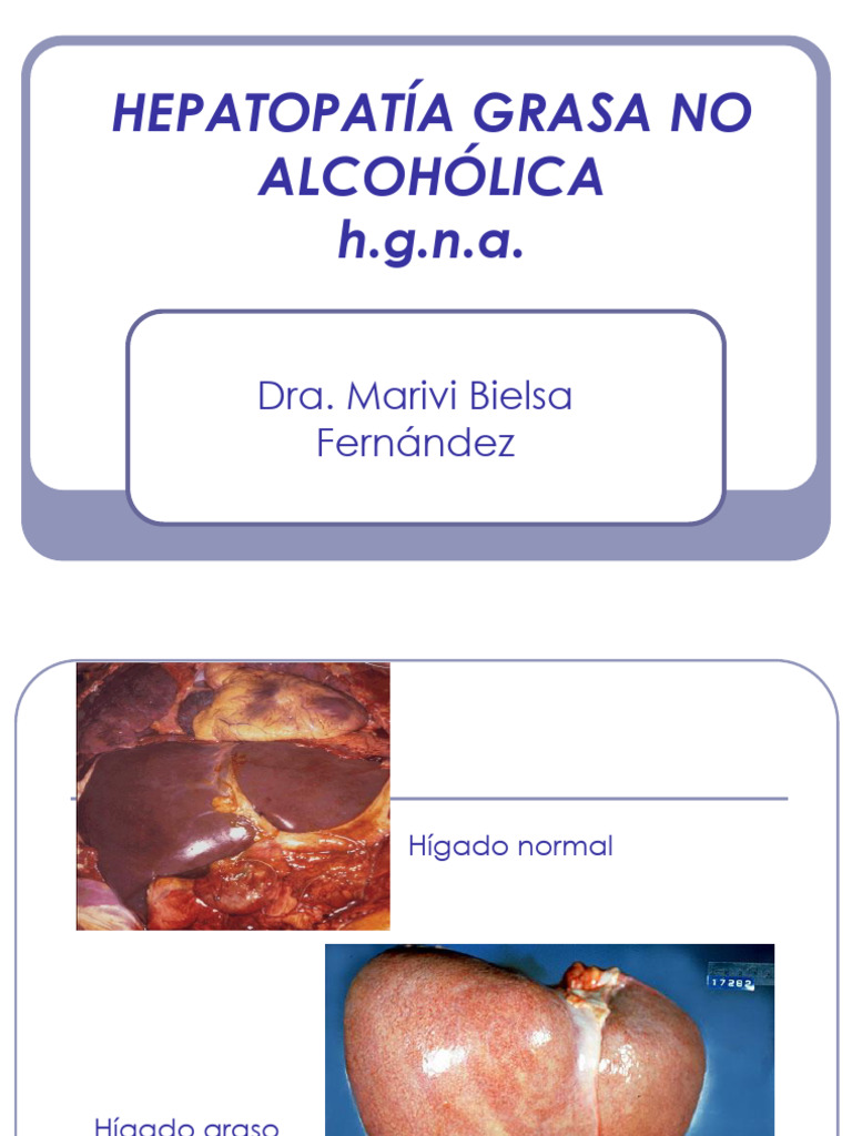 Hepatitis Grasa No Alcohólica | PDF