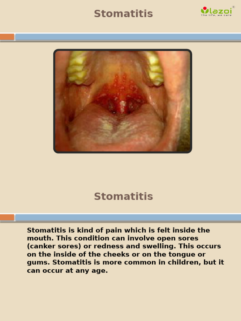 Stomatitis Causes Symptoms | PDF