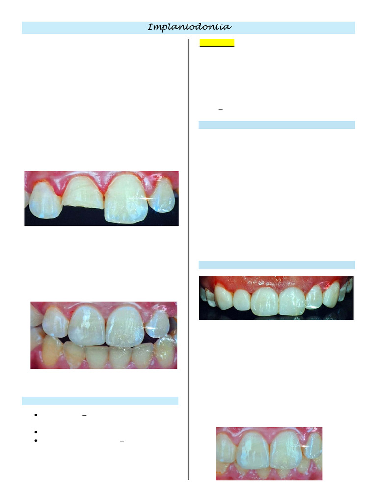 Implant Odonto Tia 2 | PDF