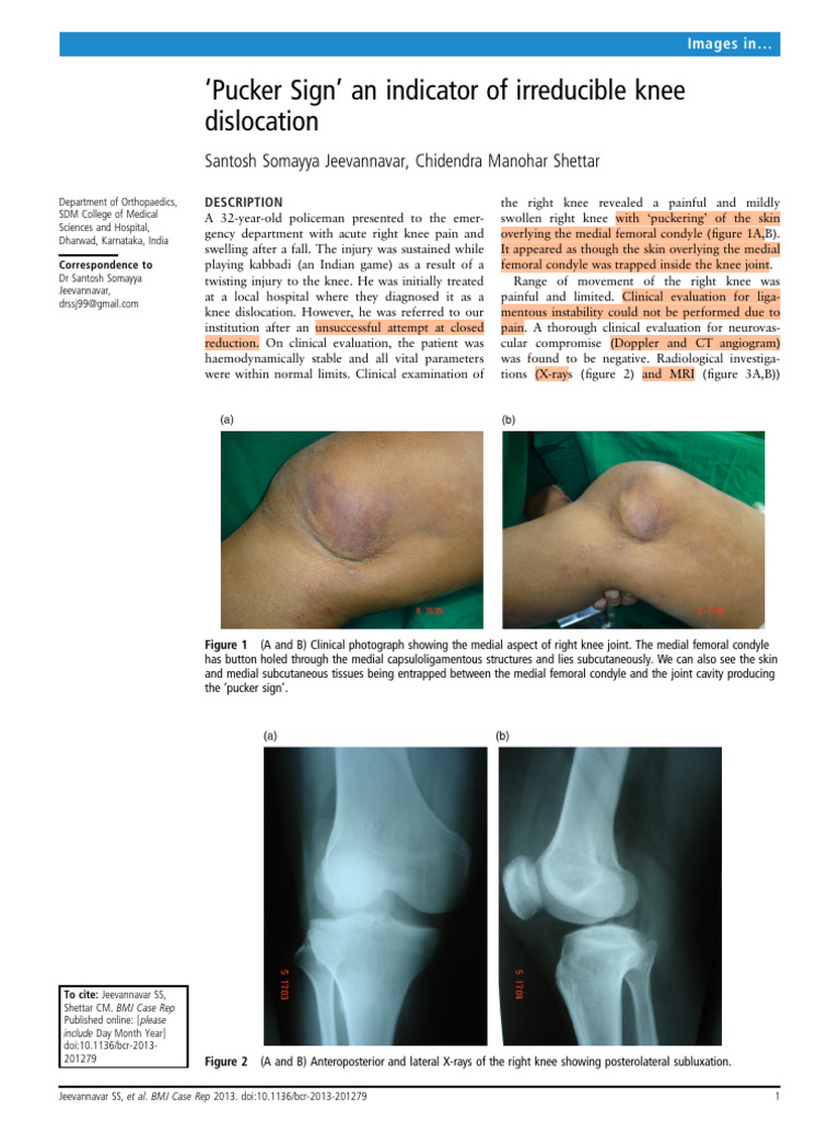 Pucker Sign an Indicator of Irreducible Knee Dislocation | PDF