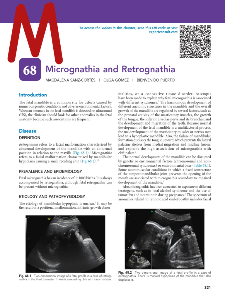 Micro and Retrognathia | PDF