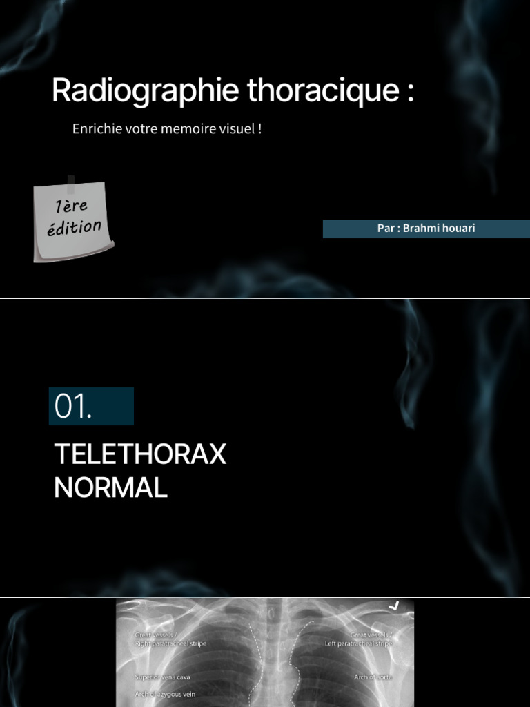 Ultimate Telethorax | PDF