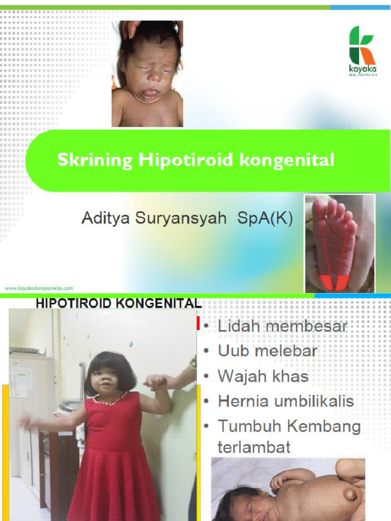 hIPERTIROID KONGENITAL | PDF