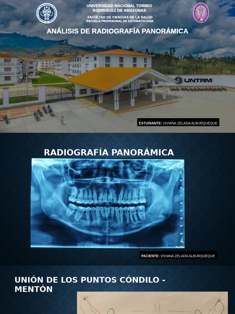 Analisis de Radiografia Panoramica | PDF